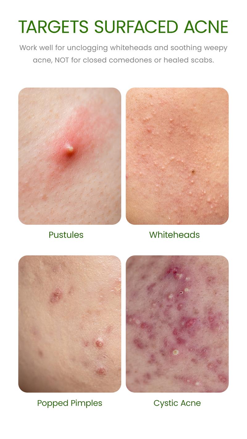 Amifiy Pimple Patches with Hydrocolloid & Tea Tree – Korean Skincare ...